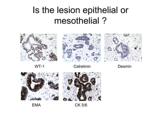 Deferential diagnosis of mesothelial proliferations and neoplasms | PPT