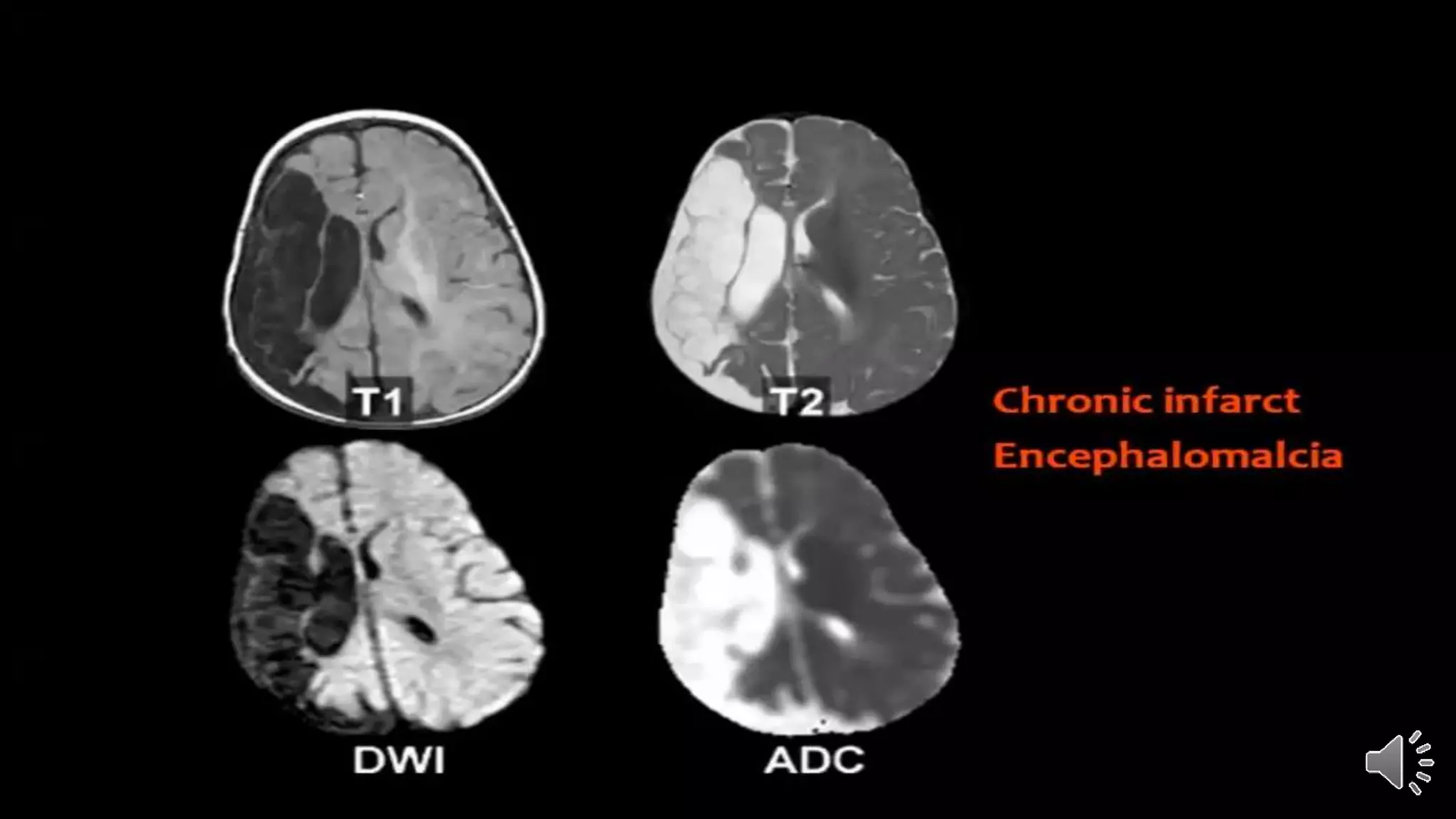 MRI Diffusion | PPTX