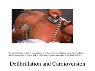 Defibrillation and cardioversion | PDF