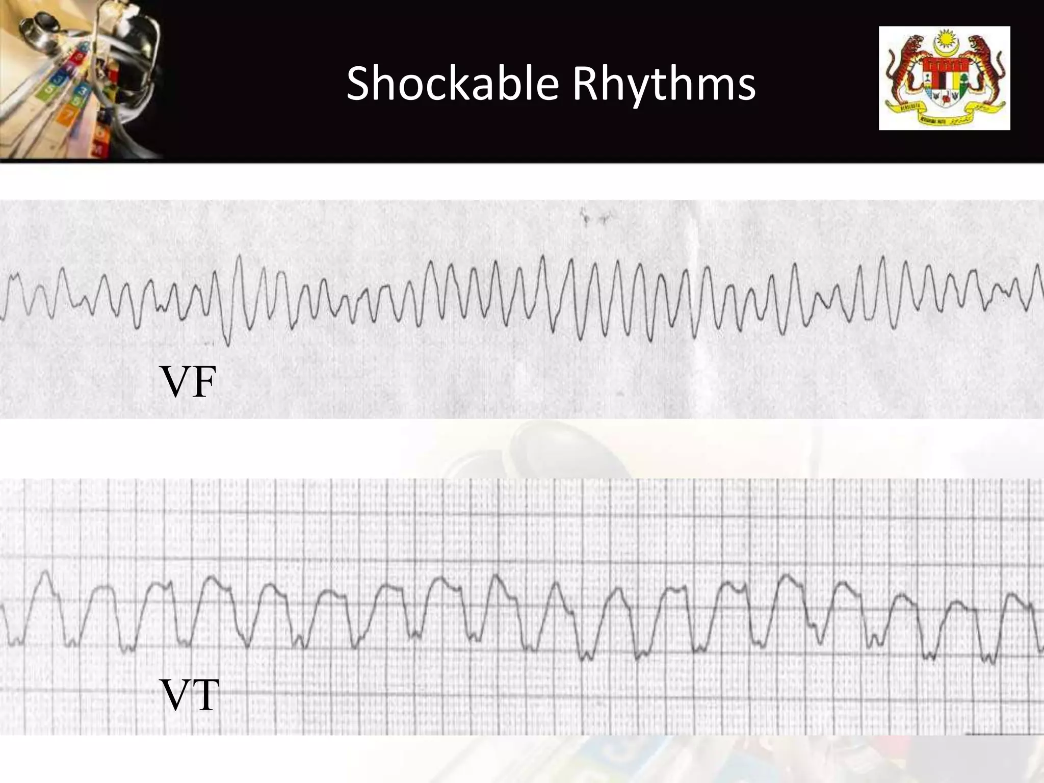 Defibrillation | PPTX
