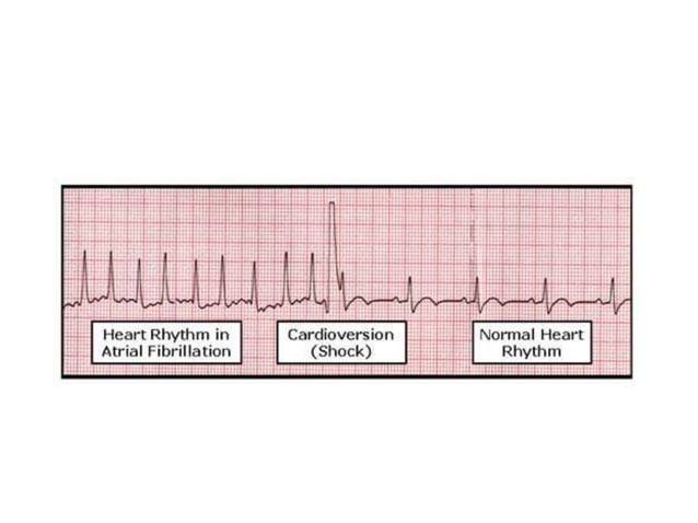 Defibrillation -cardioversion Cardioversion is a medical procedure by ...
