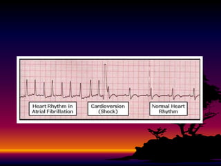 defibrillation-amp-cardioversion good.ppt | First Aid | Injuries