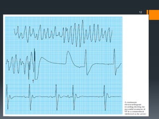 Defibrillation, cardioversion and pacing | PPTX