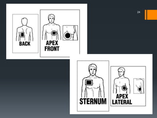 Defibrillation, cardioversion and pacing | PPTX