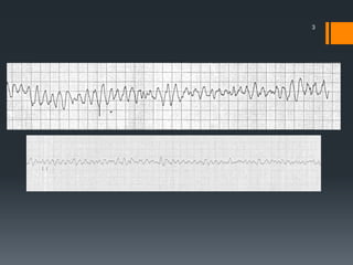 Defibrillation, cardioversion and pacing | PPTX