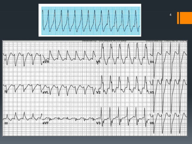 Defibrillation, cardioversion and pacing | PPTX