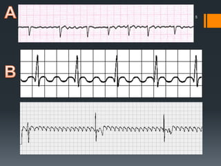 Defibrillation, cardioversion and pacing | PPTX