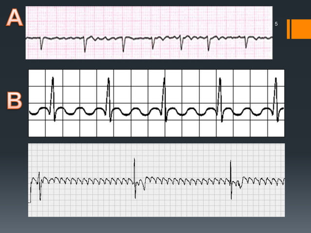 Defibrillation, cardioversion and pacing | PPT