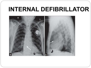 Defibrillator prakash | PPTX | First Aid | Injuries