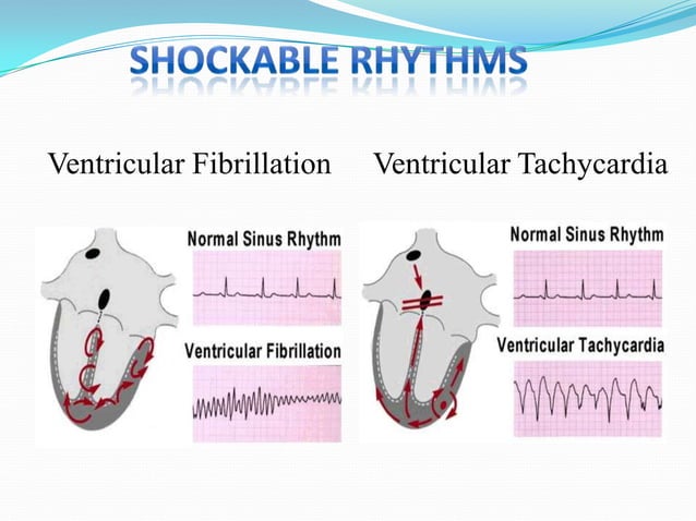 Defibrillator (ppt) | PPTX | First Aid | Injuries