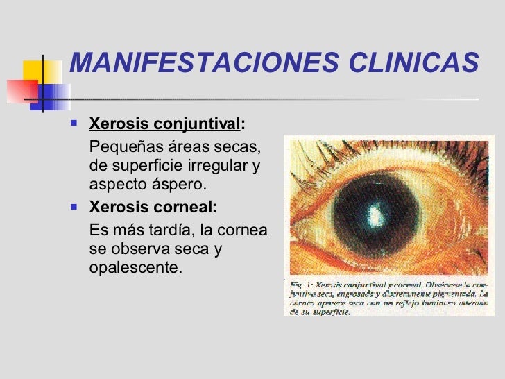 Deficiencia De Vitamina A