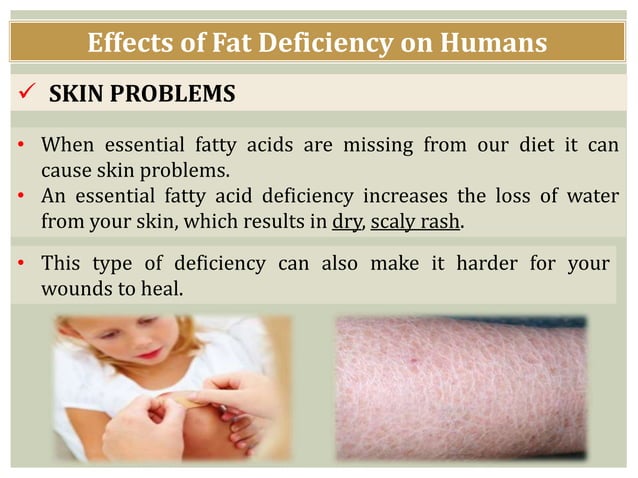 Deficiencies and Excesses of Fats | PPTX | Skin and Dermatology ...