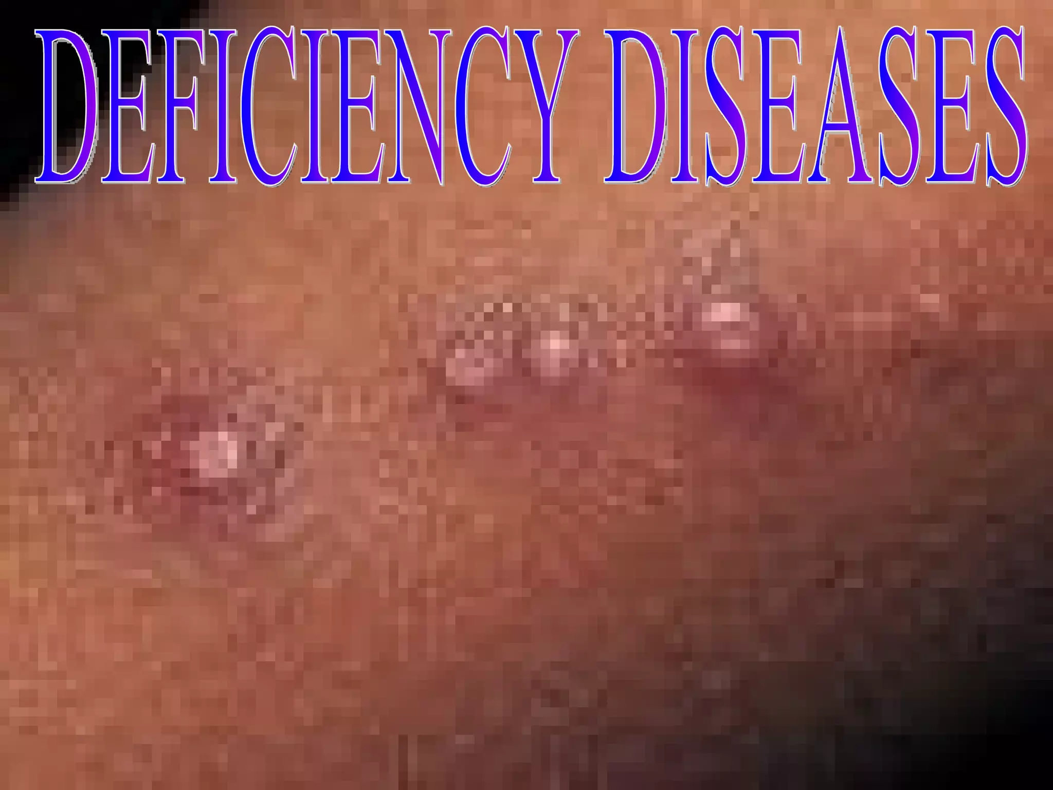 Deficiency diseases | PPT