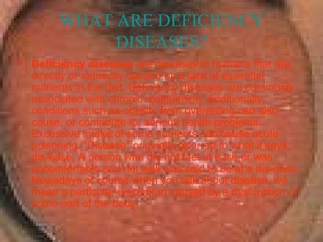 Deficiency diseases | PPT