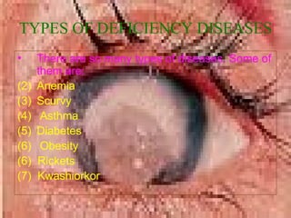 Deficiency diseases | PPT