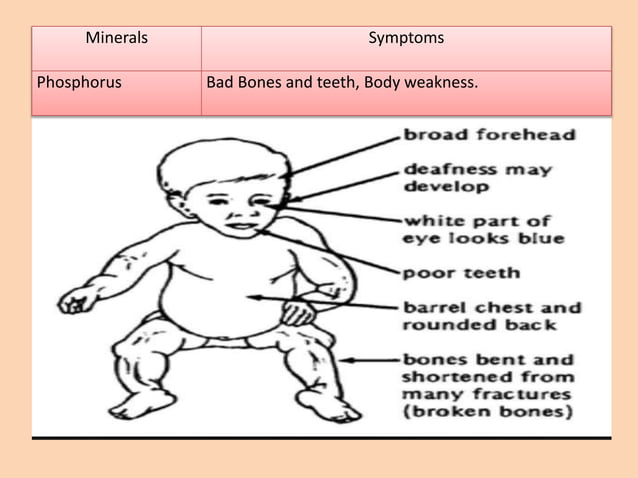 DEFICIENCY DISEASES IN NUTRITION- CLASS VI | PPTX | Bone and Joint ...