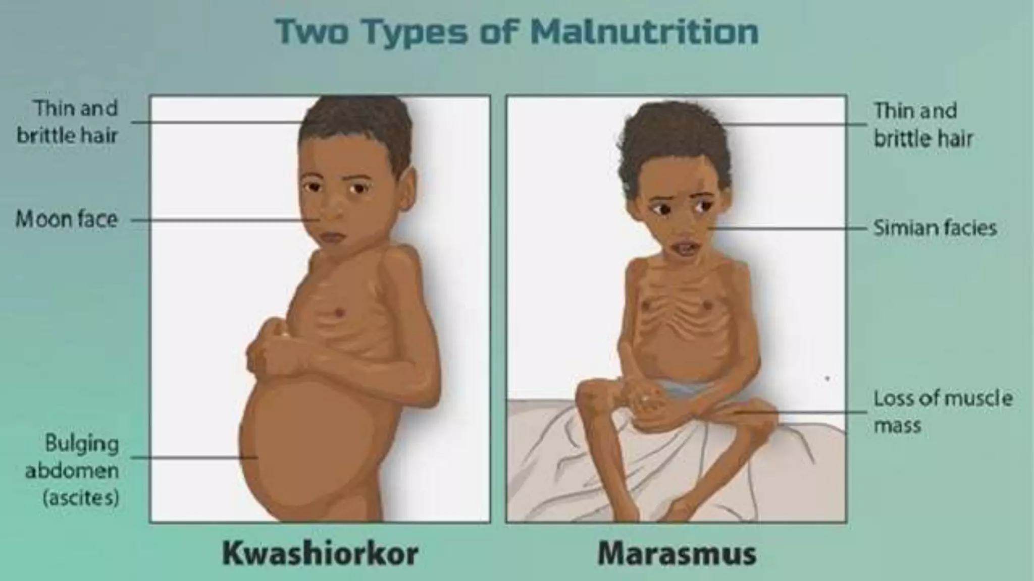Deficiency diseases of proteins, kwashiorkor, marasmus | PPTX