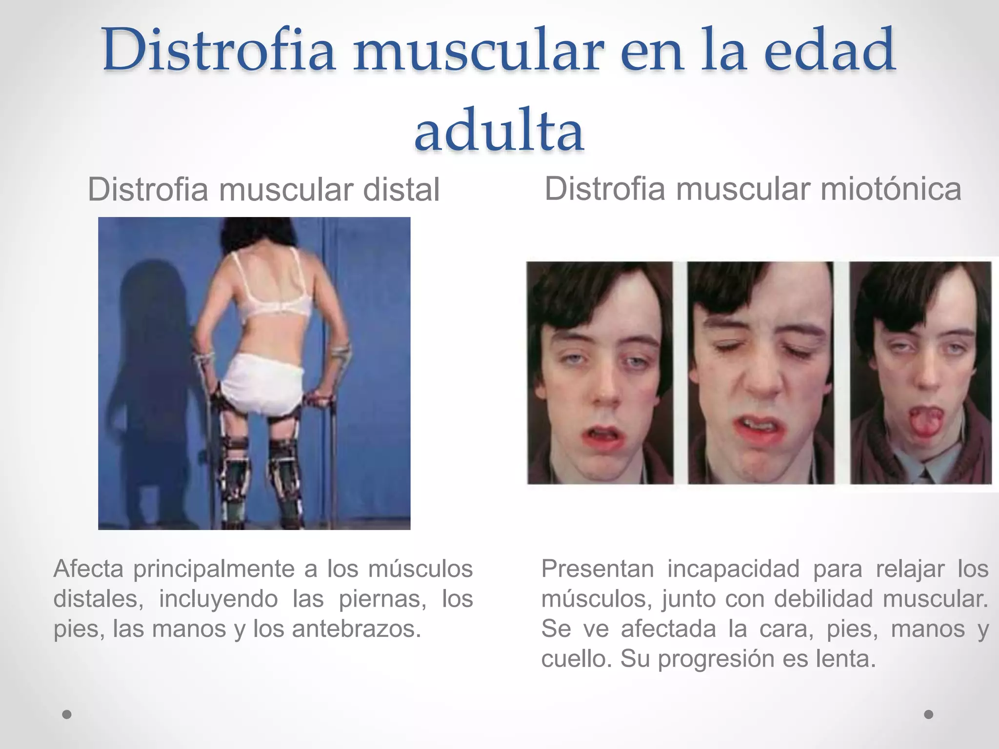 Espina Bifida y Distrofia Muscular | PPT