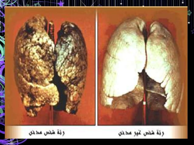 Definisi bronchitis kronis pptna | PPT