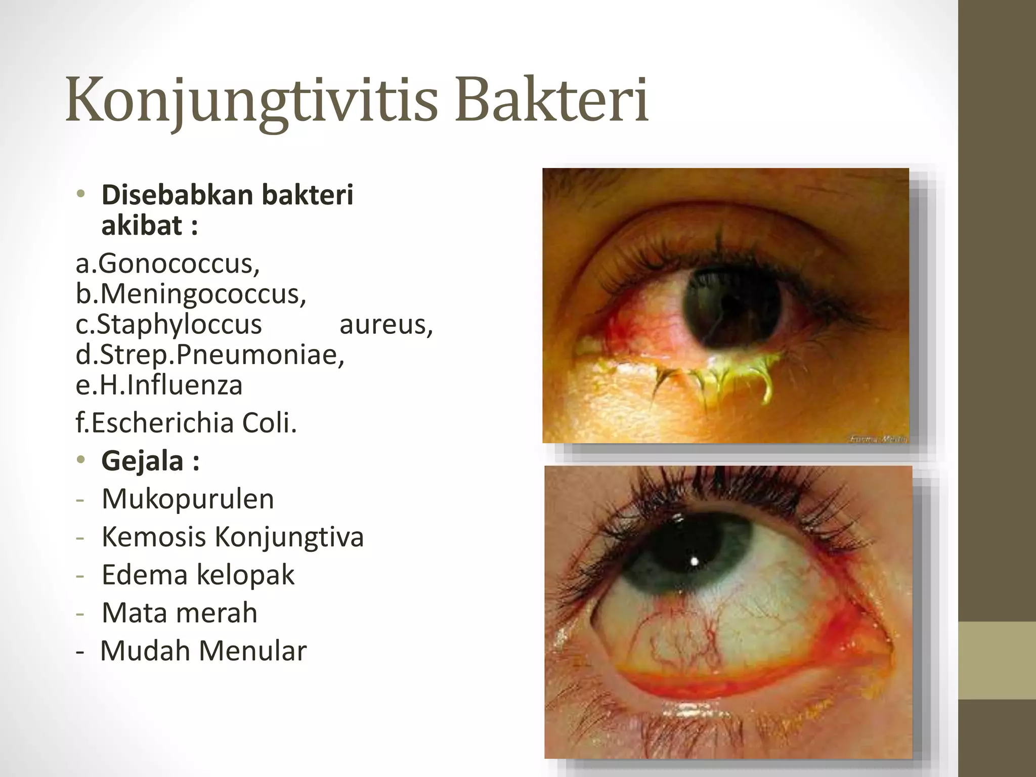 Definisi dan klasifikasi konjungtivitis | PPTX