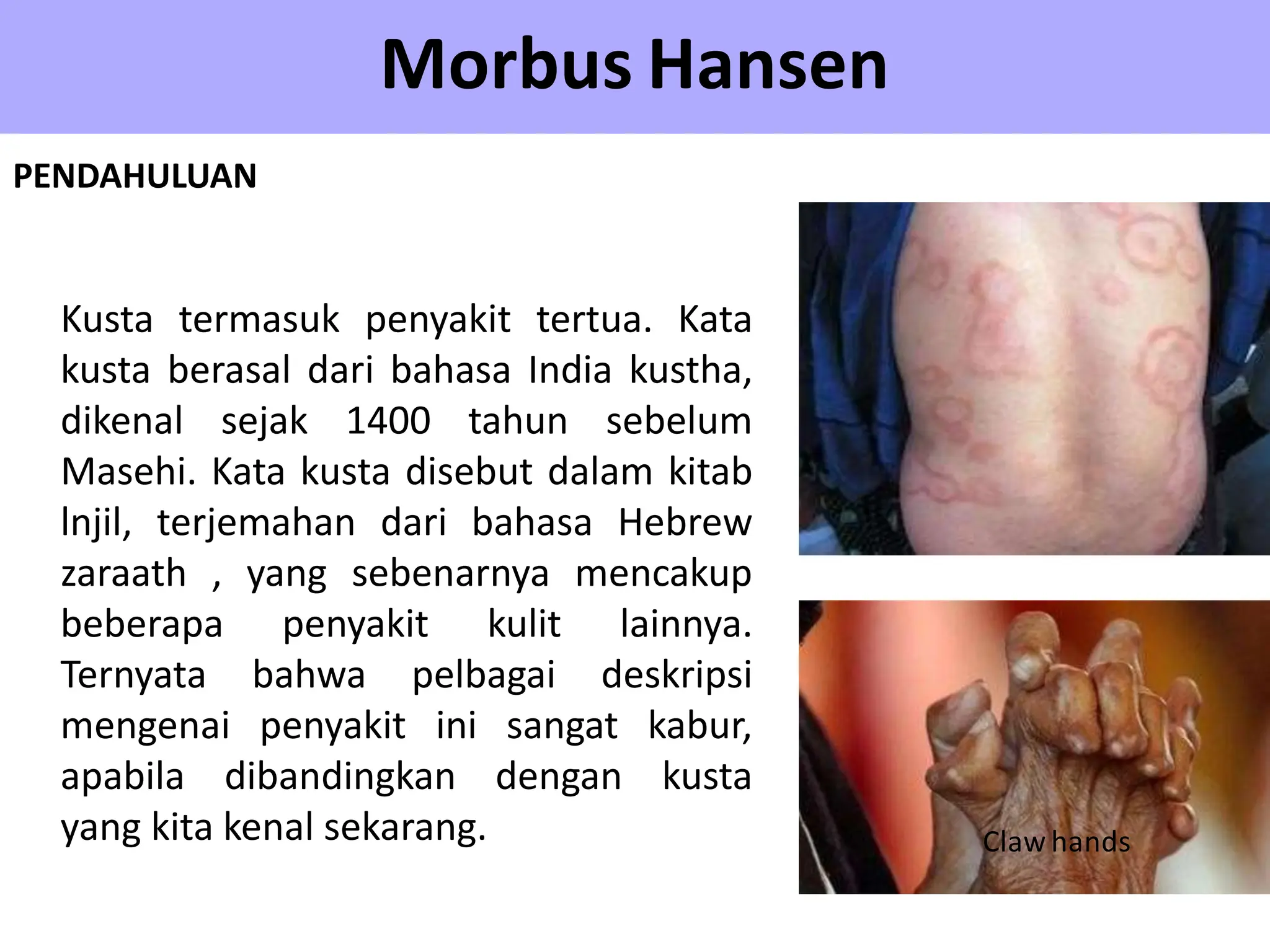 DEFINISI DAN KLASIFIKASI KUSTA INDO.pptx