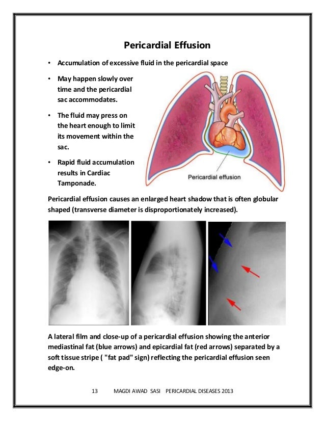 Definition 0 f pericardial diseases