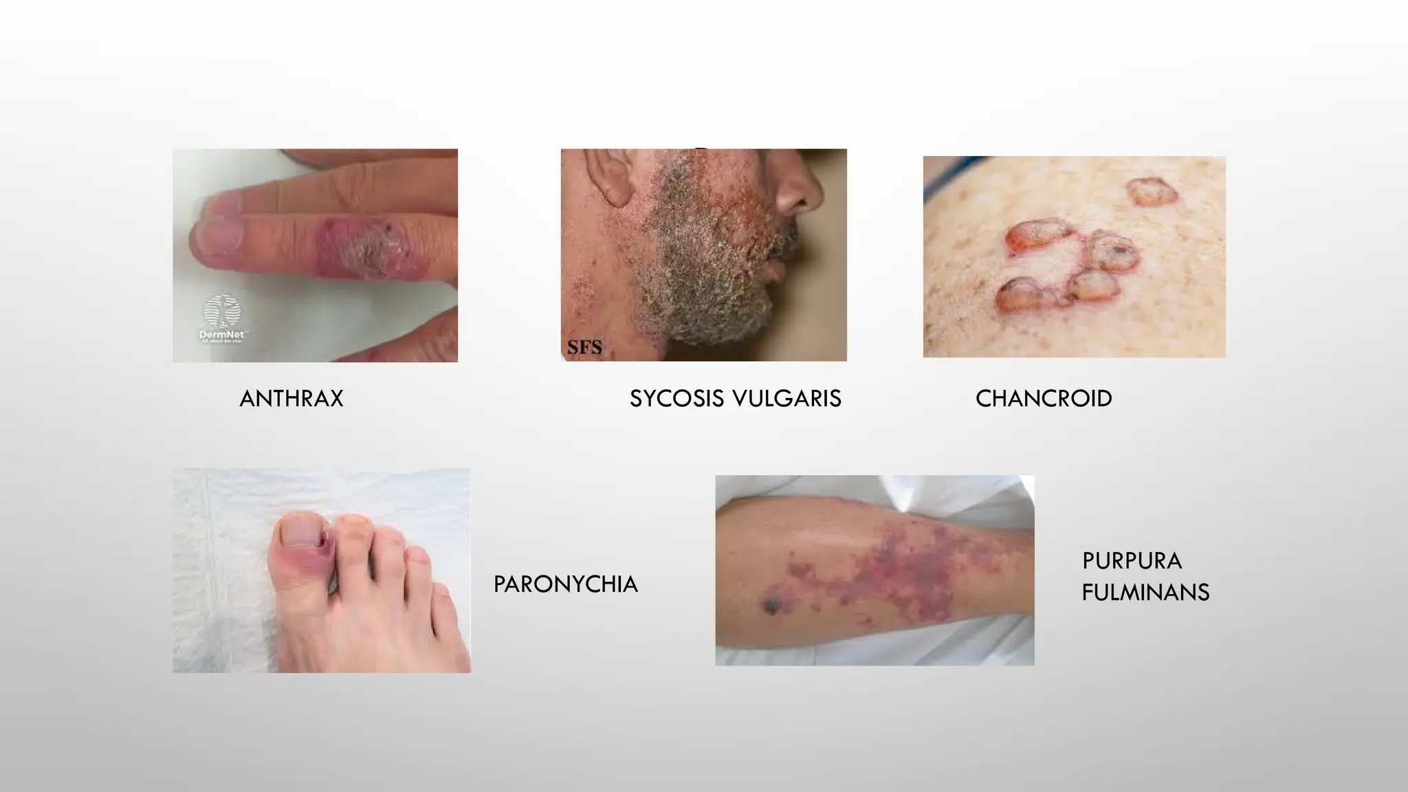 DEFINITION AND TYPES OF CUTANEOUS AND SUBCUTANEOUS INFECTIONS.pptx