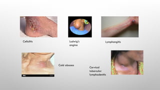 DEFINITION AND TYPES OF CUTANEOUS AND SUBCUTANEOUS INFECTIONS.pptx