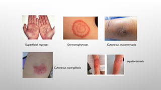 DEFINITION AND TYPES OF CUTANEOUS AND SUBCUTANEOUS INFECTIONS.pptx