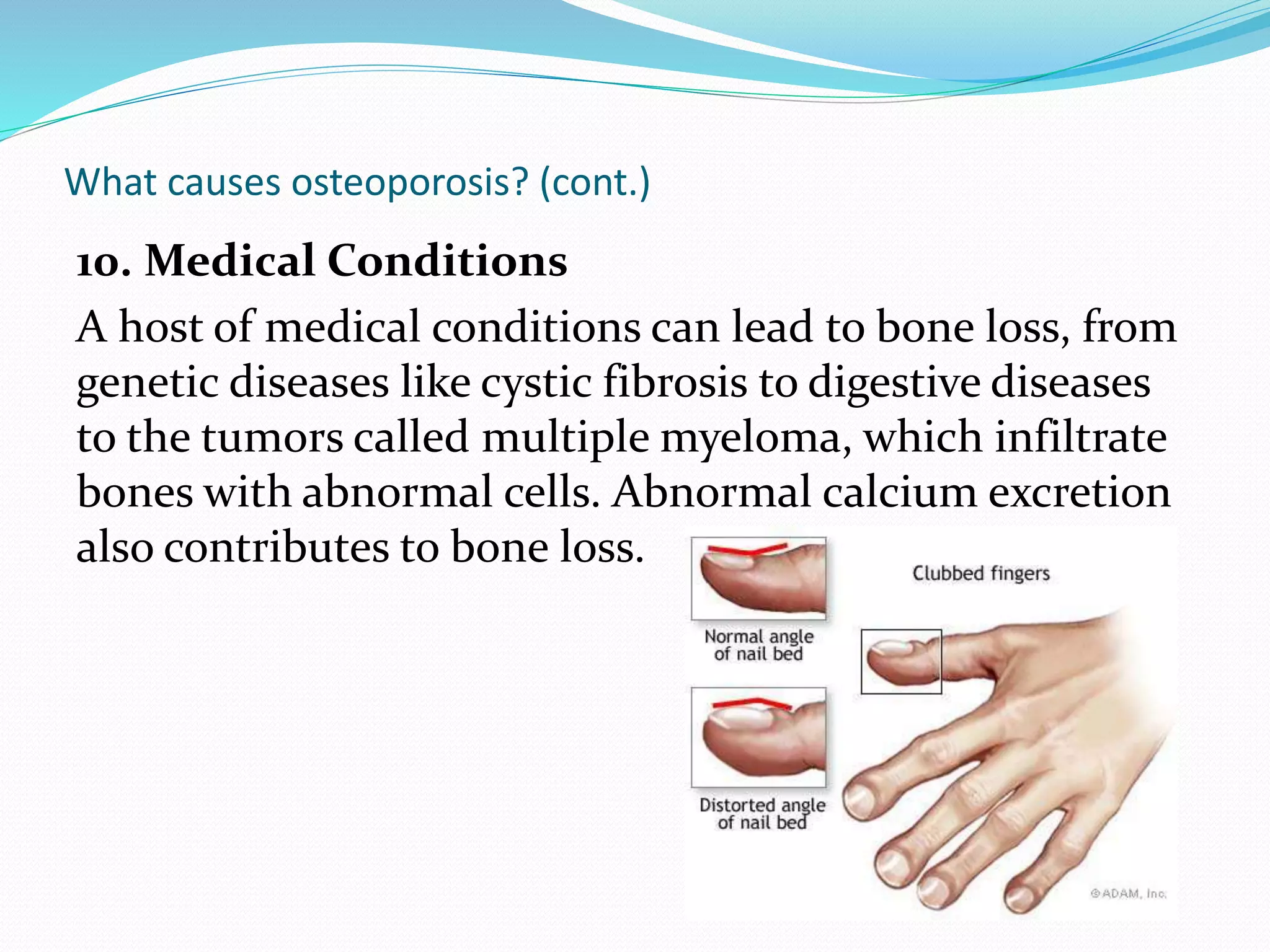 Definition & causes of Osteoporosis | PPTX