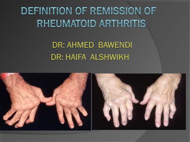 Definition of remission of ra | PPT | Diseases and Conditions | Medical ...