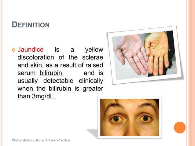 Definition & types of jaundice | PPTX | Blood Disorders | Diseases and ...