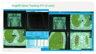 SBRT robotizada (Cyberknife) Tumores pulmonares | PPTX