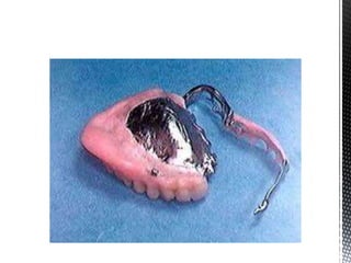 Definitive obturator | PPTX