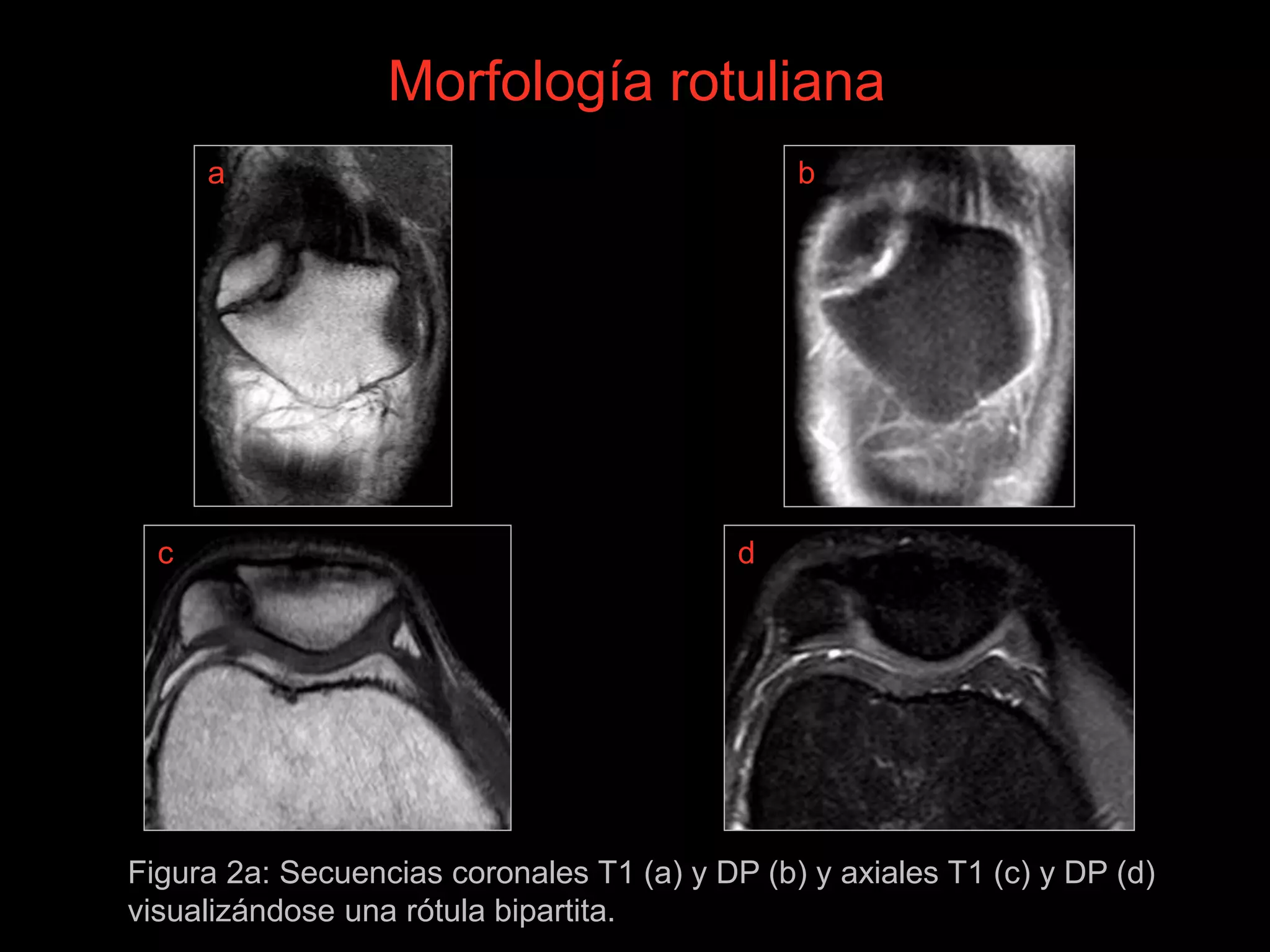 resonancia de rodilla.ppt