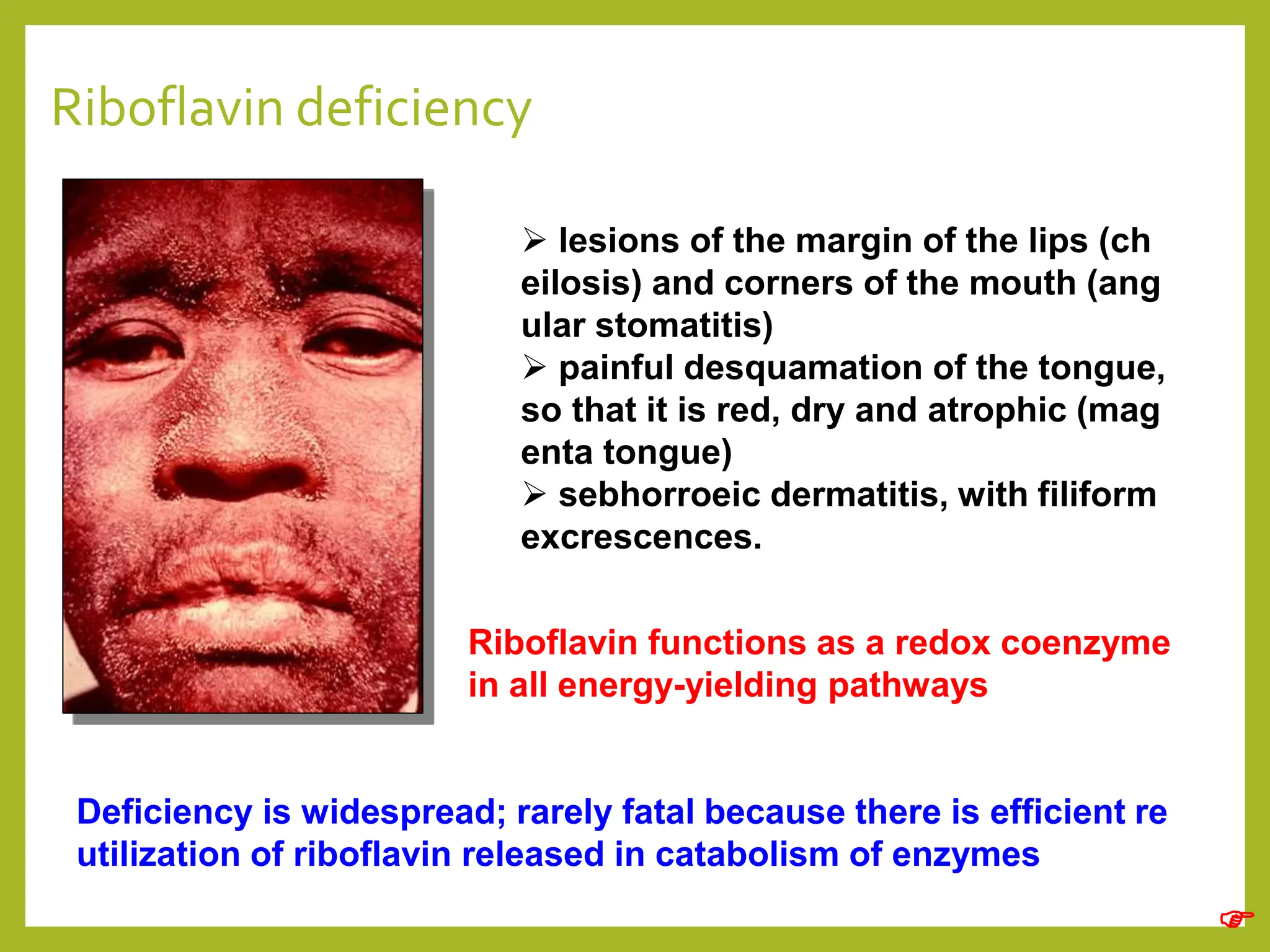 Defisiensi vitamin dan mineral FK UNS.pptx