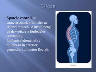 Deformațiunile coloanei vertebrale. | PPTX