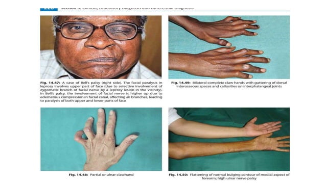 DEFORMATIES IN LEPROSY.pptx