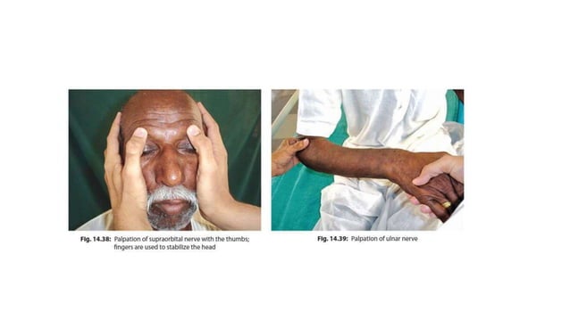 DEFORMATIES IN LEPROSY.pptx