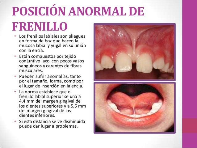 Deformidades andquirida periodoncia