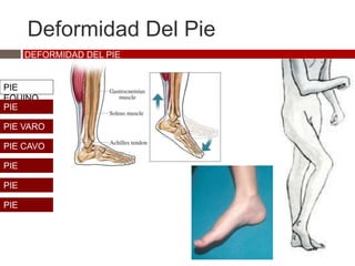 Deformidades del pie | PPTX
