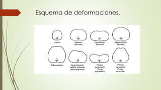 Deformidades de tórax SEMIOLOGIA | PPTX