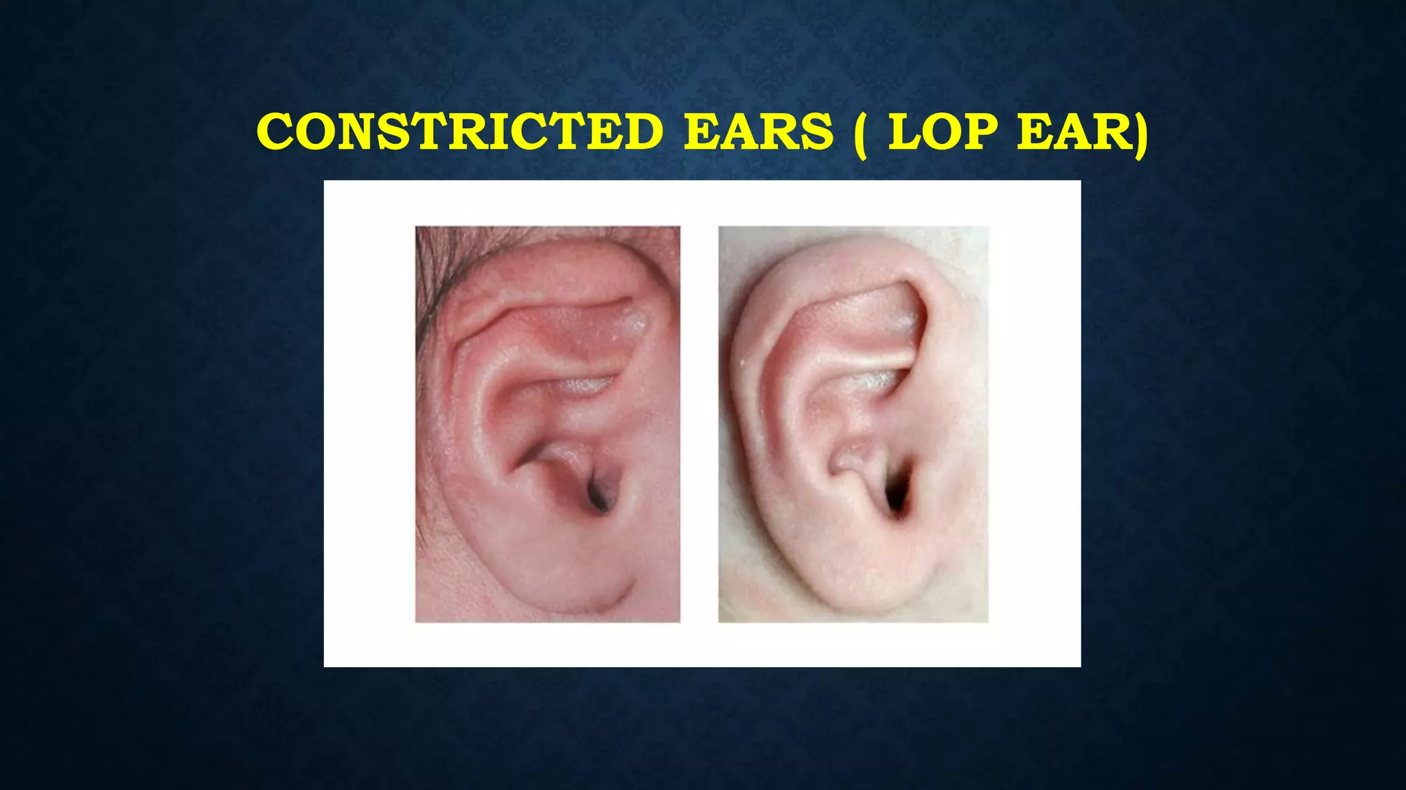 Deformities of ear | PPTX