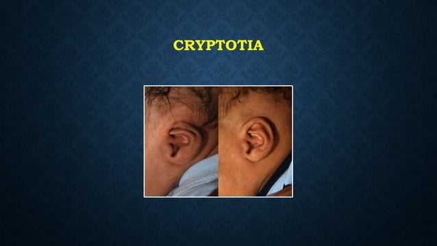 Deformities of ear | PPTX