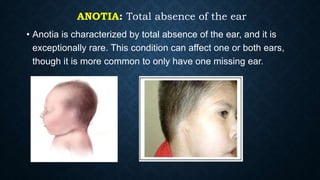Deformities of ear | PPTX