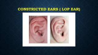 Deformities of ear | PPTX