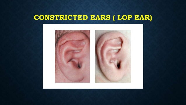 Deformities of ear | PPTX