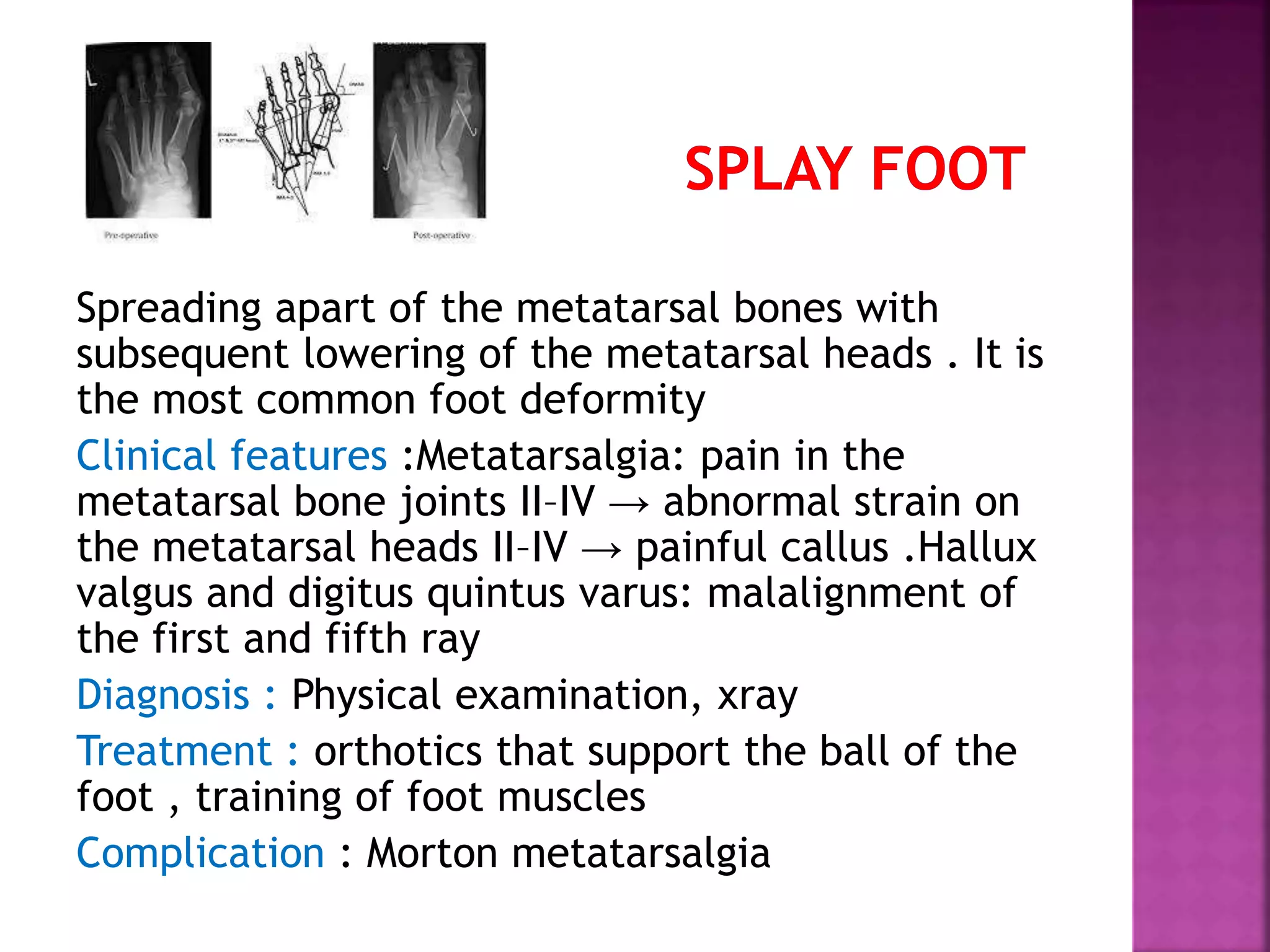 DEFORMITIES OF FOOT.pptx