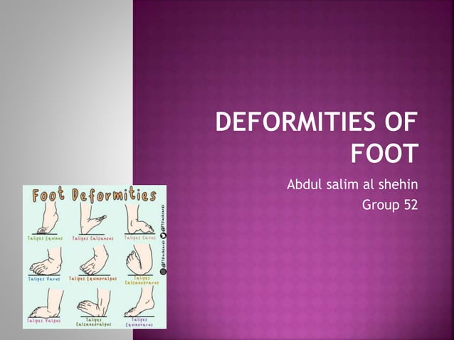 DEFORMITIES OF FOOT.pptx