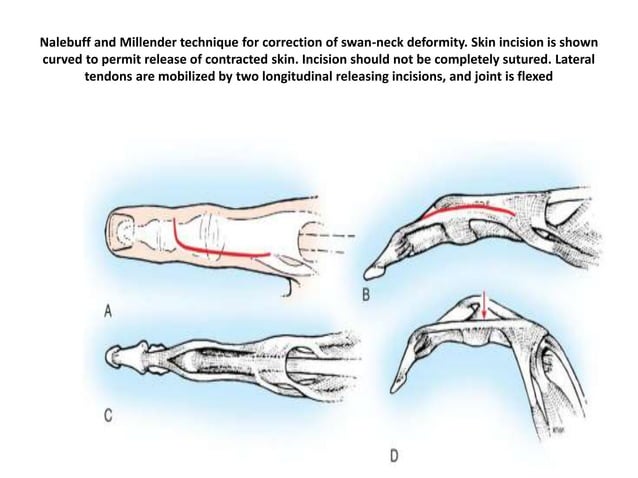 Deformities of hand in rheumatoid arthritis | PPT | Free Download